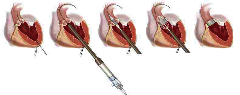 Percutaneous Aortic Valve Replacement: New Hope for Inoperable and High ...