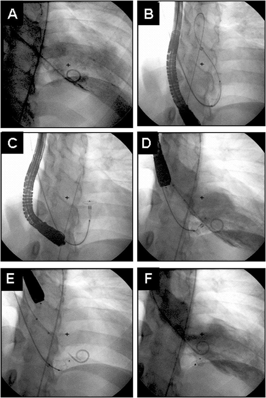 Percutaneous Closure of a Post-traumatic Muscular Ventricular Septal ...