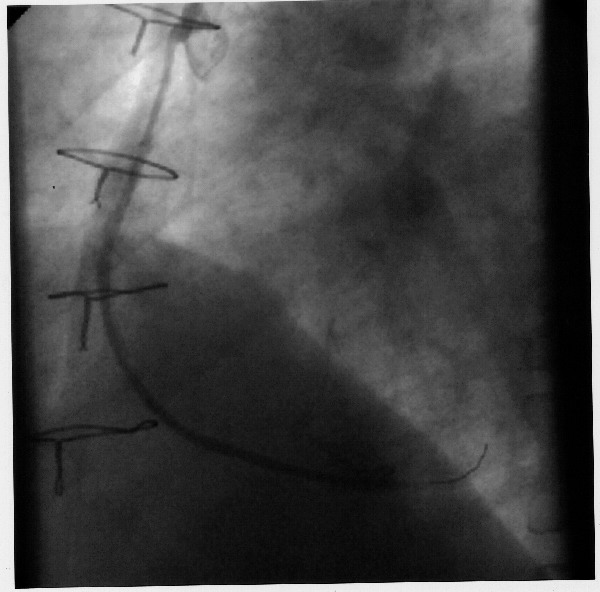 The Use Of The X Sizer‚Ñ¢ Transluminal Extraction Catheter As An Adjunct To Stenting Of Occluded