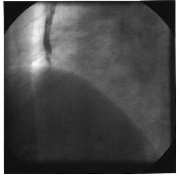 The Use Of The X Sizer‚Ñ¢ Transluminal Extraction Catheter As An Adjunct To Stenting Of Occluded