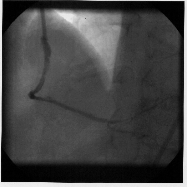 The Use Of The X Sizer‚Ñ¢ Transluminal Extraction Catheter As An Adjunct To Stenting Of Occluded