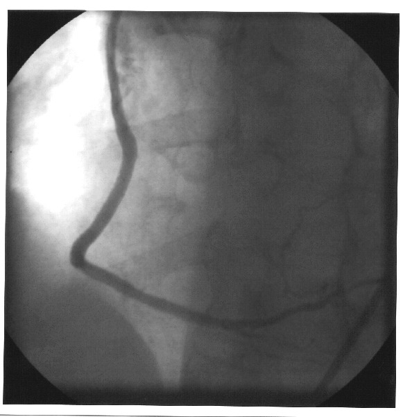 The Use Of The X Sizer‚Ñ¢ Transluminal Extraction Catheter As An Adjunct To Stenting Of Occluded