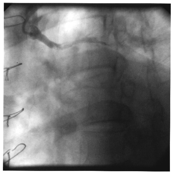 The Use Of The X Sizer‚Ñ¢ Transluminal Extraction Catheter As An Adjunct To Stenting Of Occluded