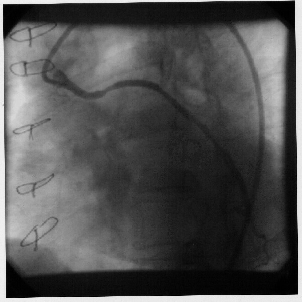 The Use Of The X Sizer‚Ñ¢ Transluminal Extraction Catheter As An Adjunct To Stenting Of Occluded