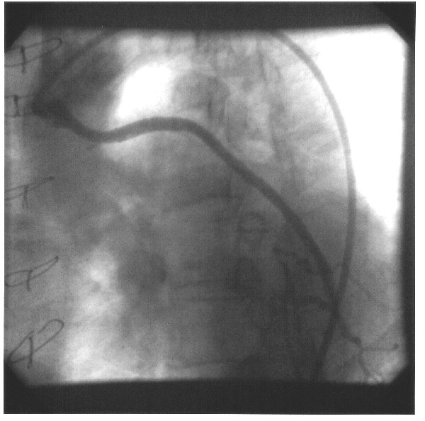 The Use Of The X Sizer‚Ñ¢ Transluminal Extraction Catheter As An Adjunct To Stenting Of Occluded