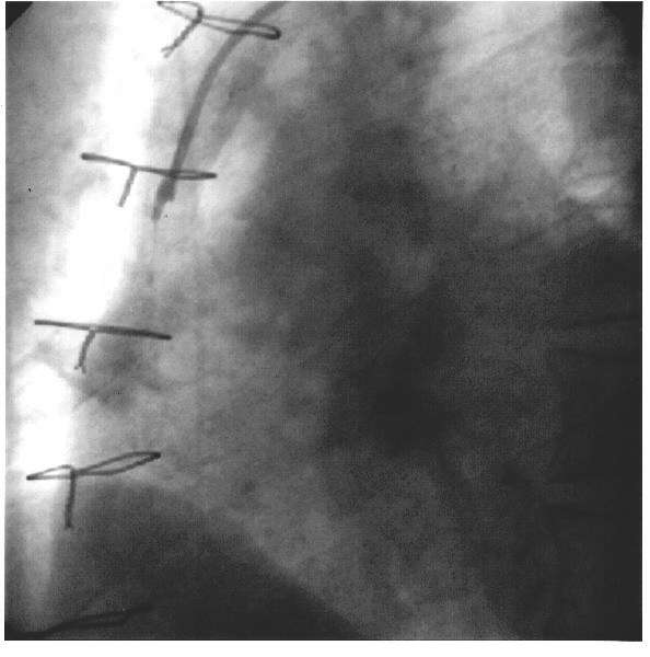 The Use Of The X Sizer‚Ñ¢ Transluminal Extraction Catheter As An Adjunct To Stenting Of Occluded