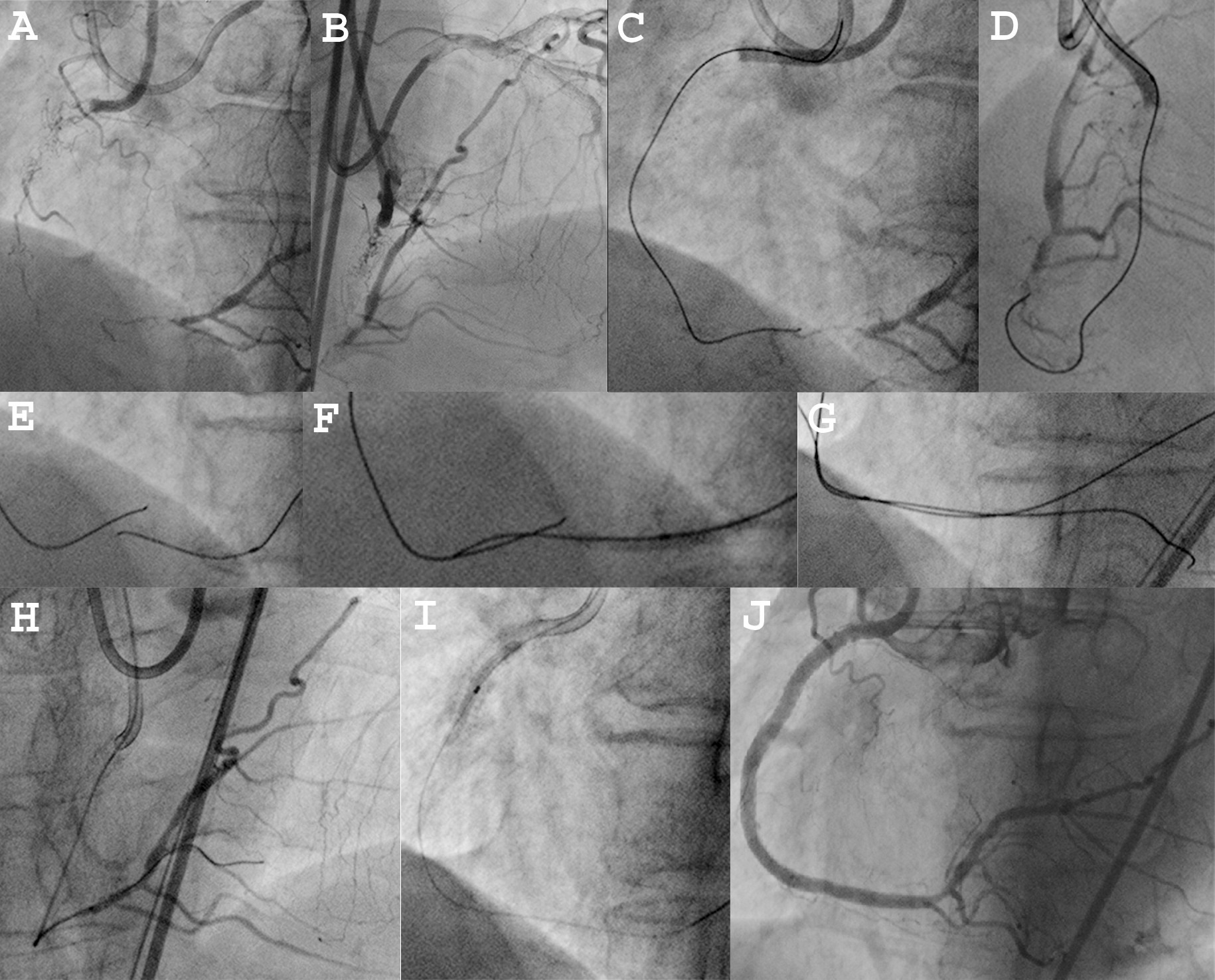 New Concept for CTO Recanalization Using Controlled Antegrade and ...