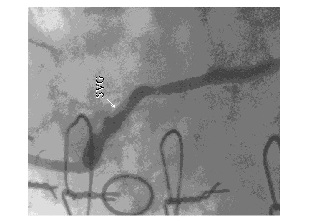 Unstable Angina In a Patient With a Single Sequential Saphenous Vein ...