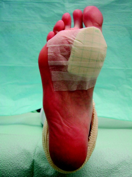 A Helpful Primer On Total Contact Casts