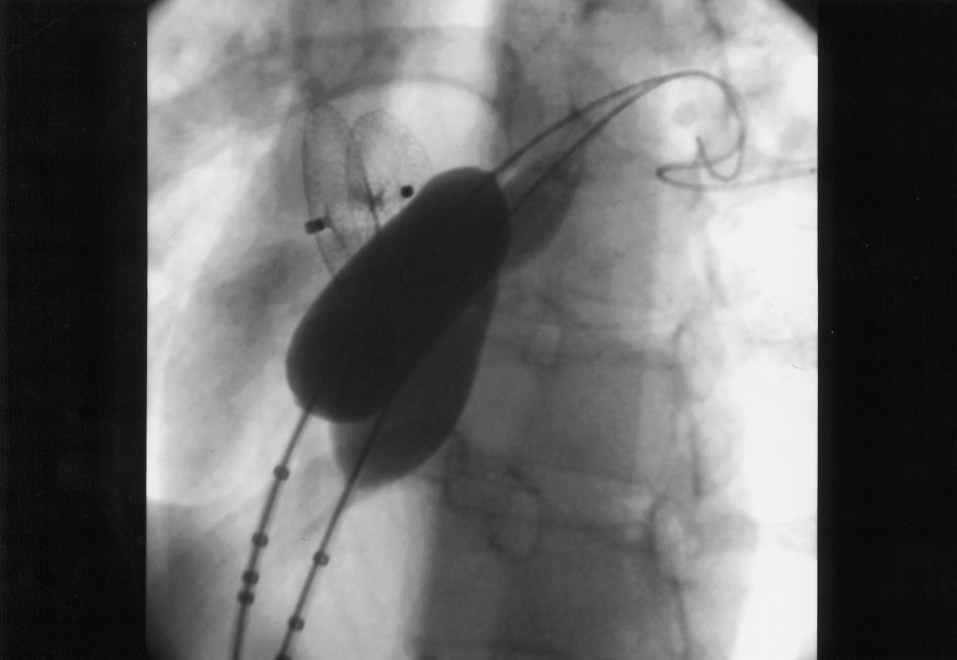 Device Closure of Fenestrated Atrial Septal Aneurysm: Difficulties and ...