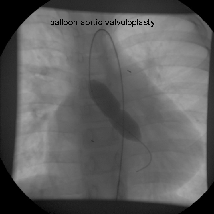 Sequential Balloon Dilatation for Combined Aortic Valvular Stenosis and ...