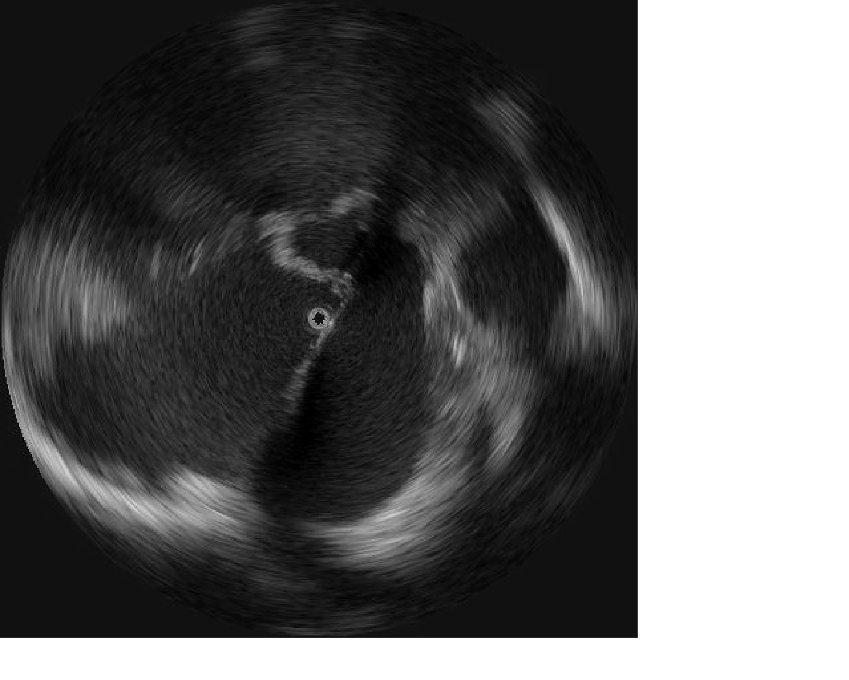 Real-Time, Three-Dimensional Localization of a Brockenbrough Needle ...