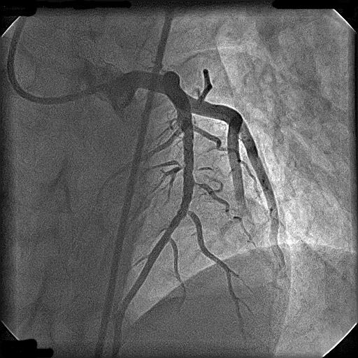Buddy Wire Technique: A simple Technique for Treating Calcified Lesion ...