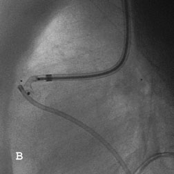 Occlusion of a Sano Shunt Using the Amplatzer Duct Occluder