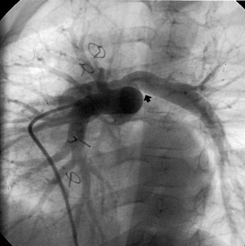 Plastic Bronchitis Occurring Late after the Fontan Procedure in a Child ...