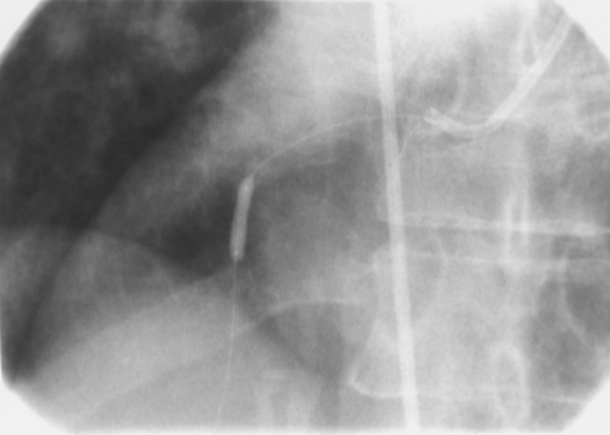 Mechanical Reperfusion during Acute Myocardial Infarction in a Patient ...