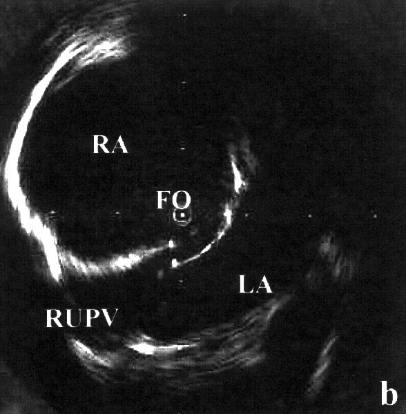Intracardiac Echocardiography and Transcranial Doppler Ultrasound to ...