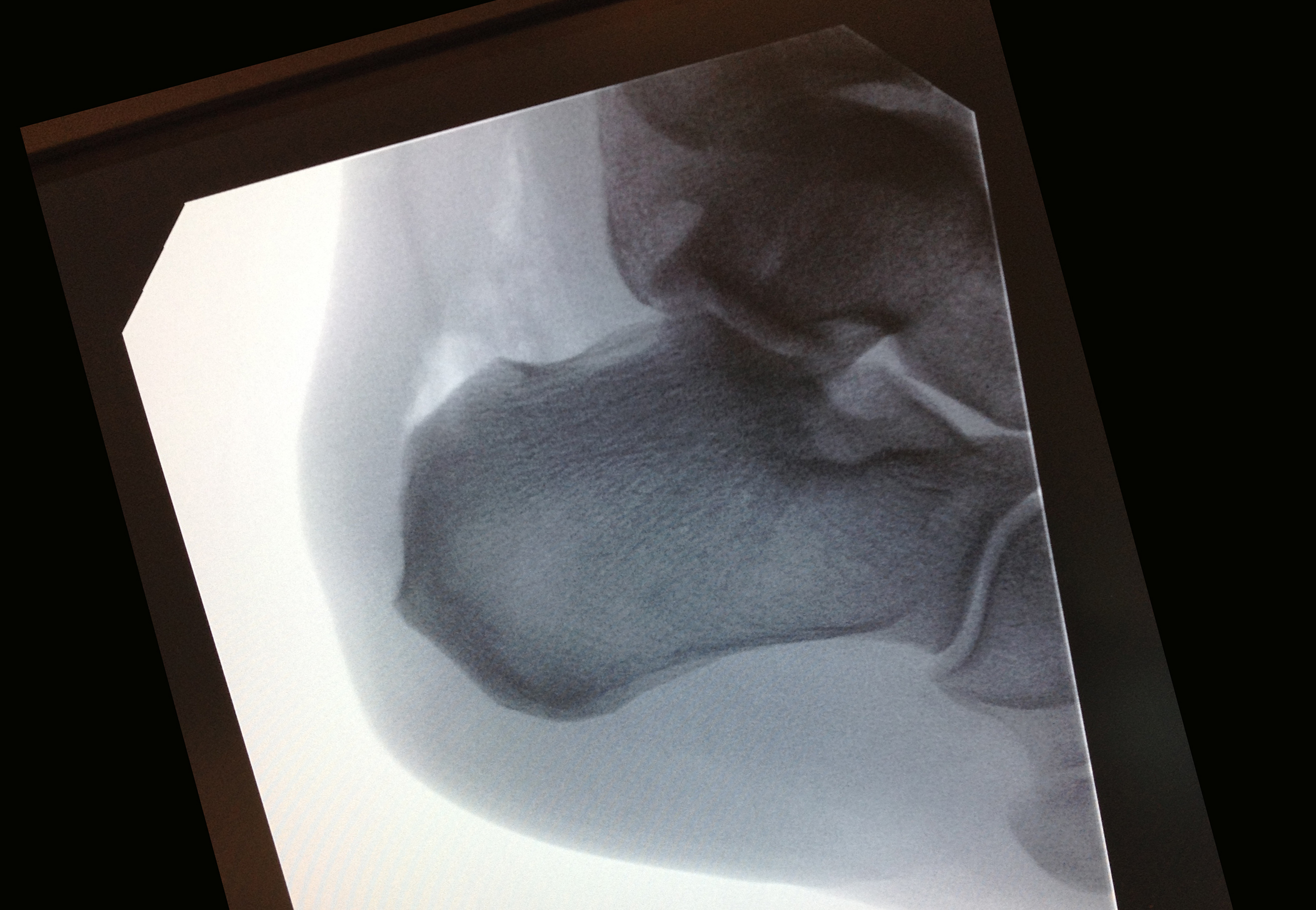 Key Pearls For Treating Haglund’s Deformity In Runners