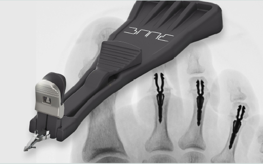 A Closer Look At A New Nitinol Hammertoe Implant