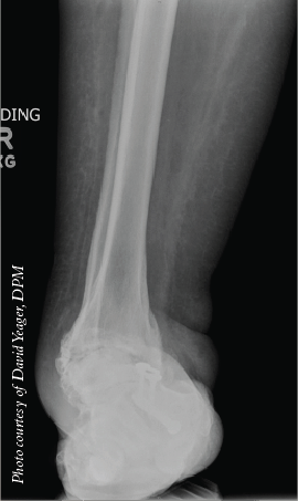 Assessing The Talectomy For Charcot Ankle Deformity