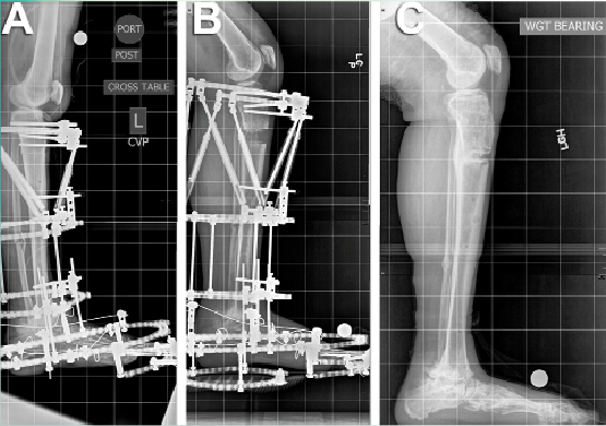 A Closer Look At The Potential Of Bone Lengthening Distraction Osteogenesis