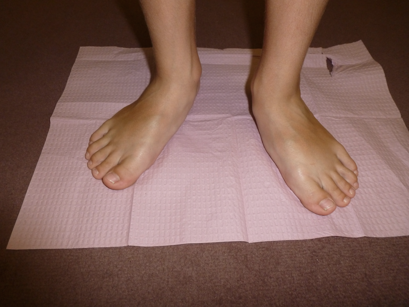 Point-Counterpoint: Asymptomatic Pediatric Flatfoot: Should You Treat It?
