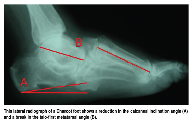 The Charcot Foot: What You Need to Know
