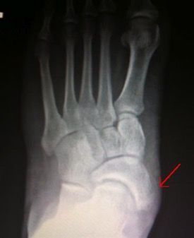 Assessing The Structural And Biomechanical Causes Of Navicular Stress ...