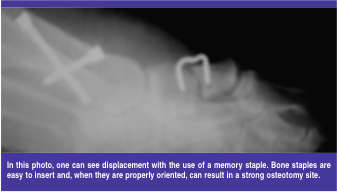 Expert Insights On Performing The Akin Osteotomy