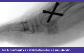 Expert Insights On Performing The Akin Osteotomy