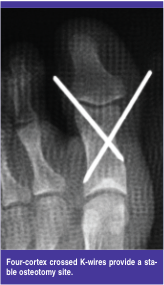 Expert Insights On Performing The Akin Osteotomy