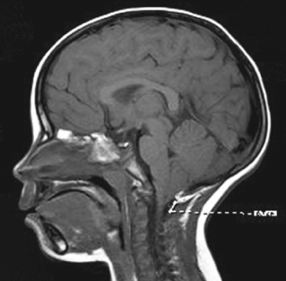 Chiari I Malformation