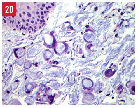 Gastric Signet-Ring Cell Carcinoma With Bladder Metastasis