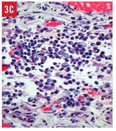 Gastric Signet-Ring Cell Carcinoma With Bladder Metastasis