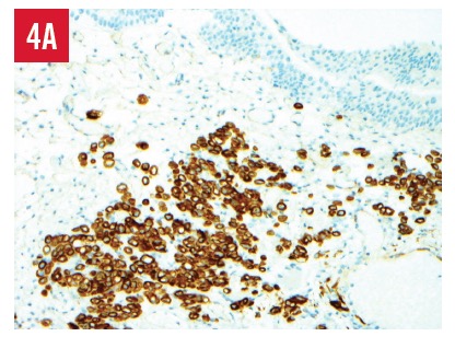 Gastric Signet-Ring Cell Carcinoma With Bladder Metastasis