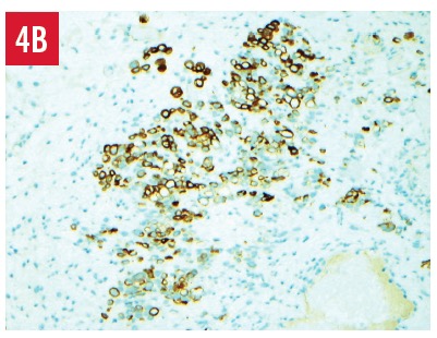 Gastric Signet-Ring Cell Carcinoma With Bladder Metastasis