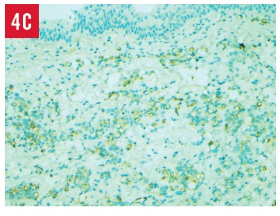 Gastric Signet-Ring Cell Carcinoma With Bladder Metastasis