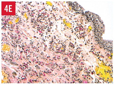 Gastric Signet-Ring Cell Carcinoma With Bladder Metastasis