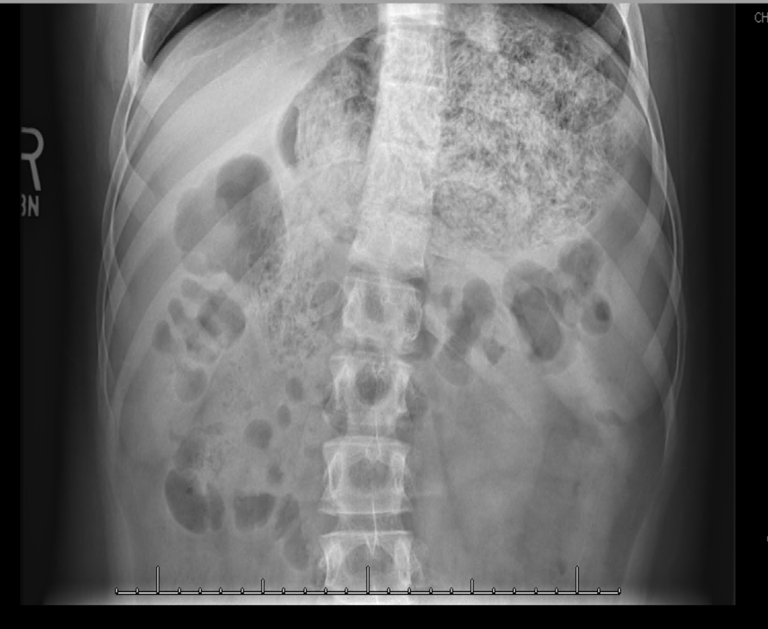 Bezoar as a Result of Plastikophagia | Gastroenterology | HMP Global