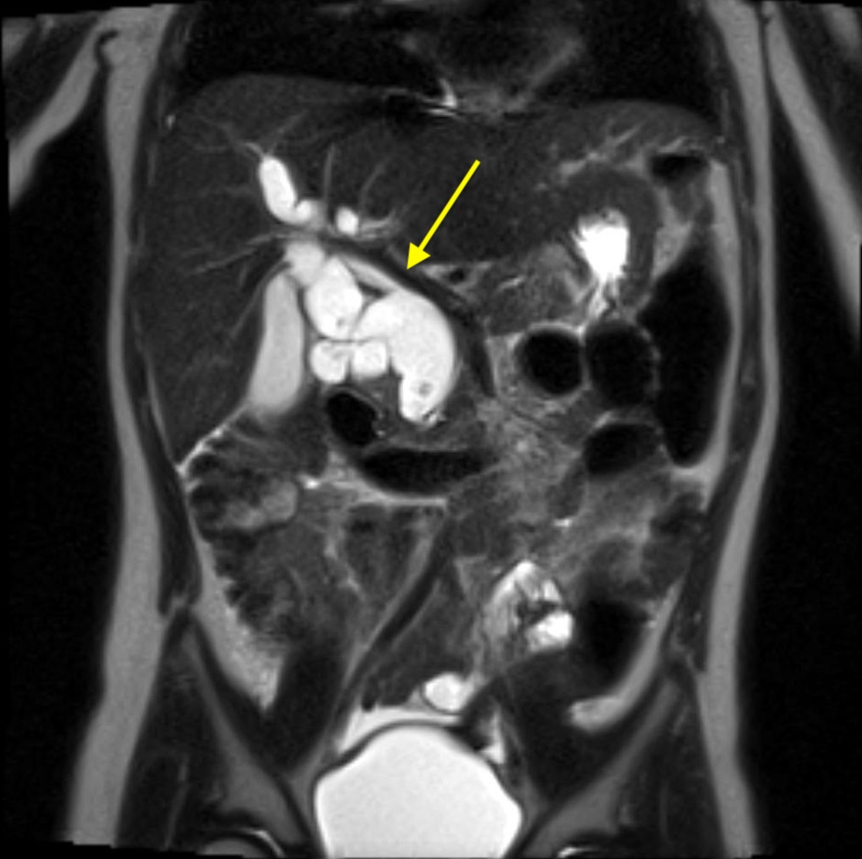 Choledochal Cyst
