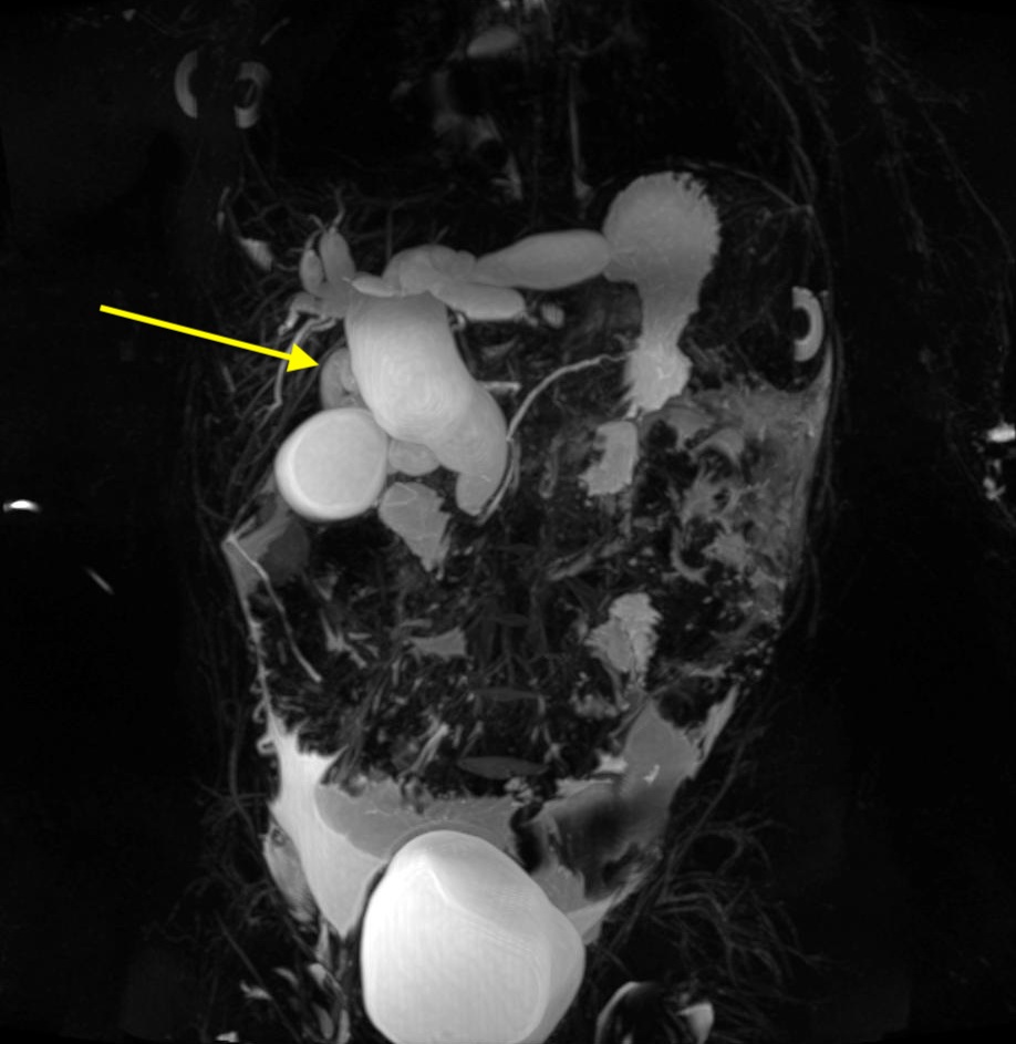 Choledochal Cyst