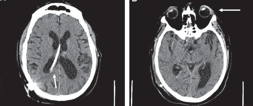 CT Evidence of Seizure Activity