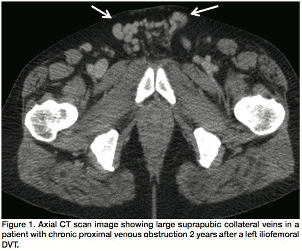 Endovascular Management of Chronic Inferior Vena Cava and Iliac Vein ...