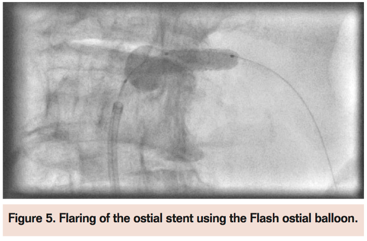 Treatment of Ostial Renal Artery Stenosis With Stenting Followed by ...