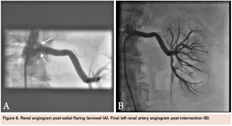 Treatment of Ostial Renal Artery Stenosis With Stenting Followed by ...