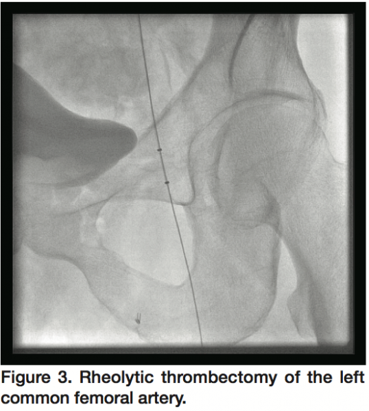 Successful Endovascular Treatment of Common Femoral Artery Thrombosis ...