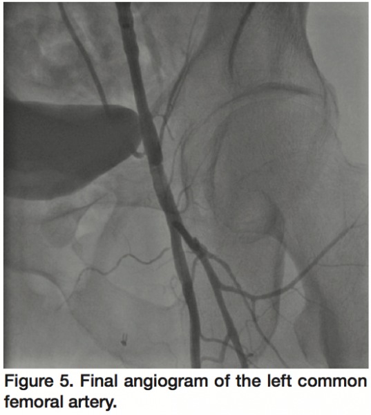 Successful Endovascular Treatment of Common Femoral Artery Thrombosis ...