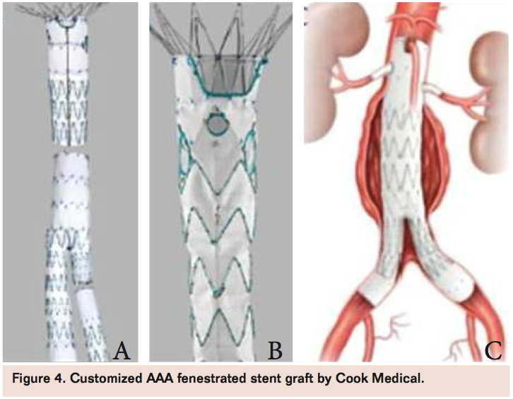 EVAR 2012: Indications, Devices, and Techniques