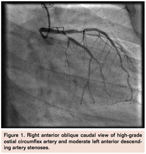Radial Access for PCI in Children with Obstructive Coronary Artery Disease