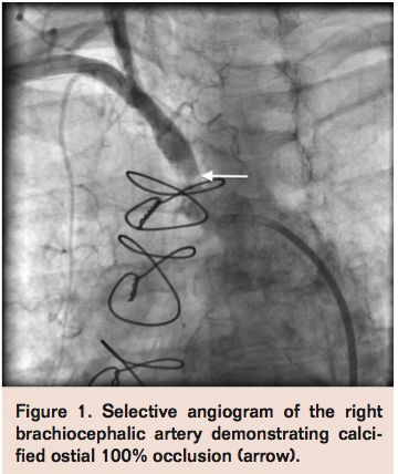 Retrograde Flow Vertebral Artery